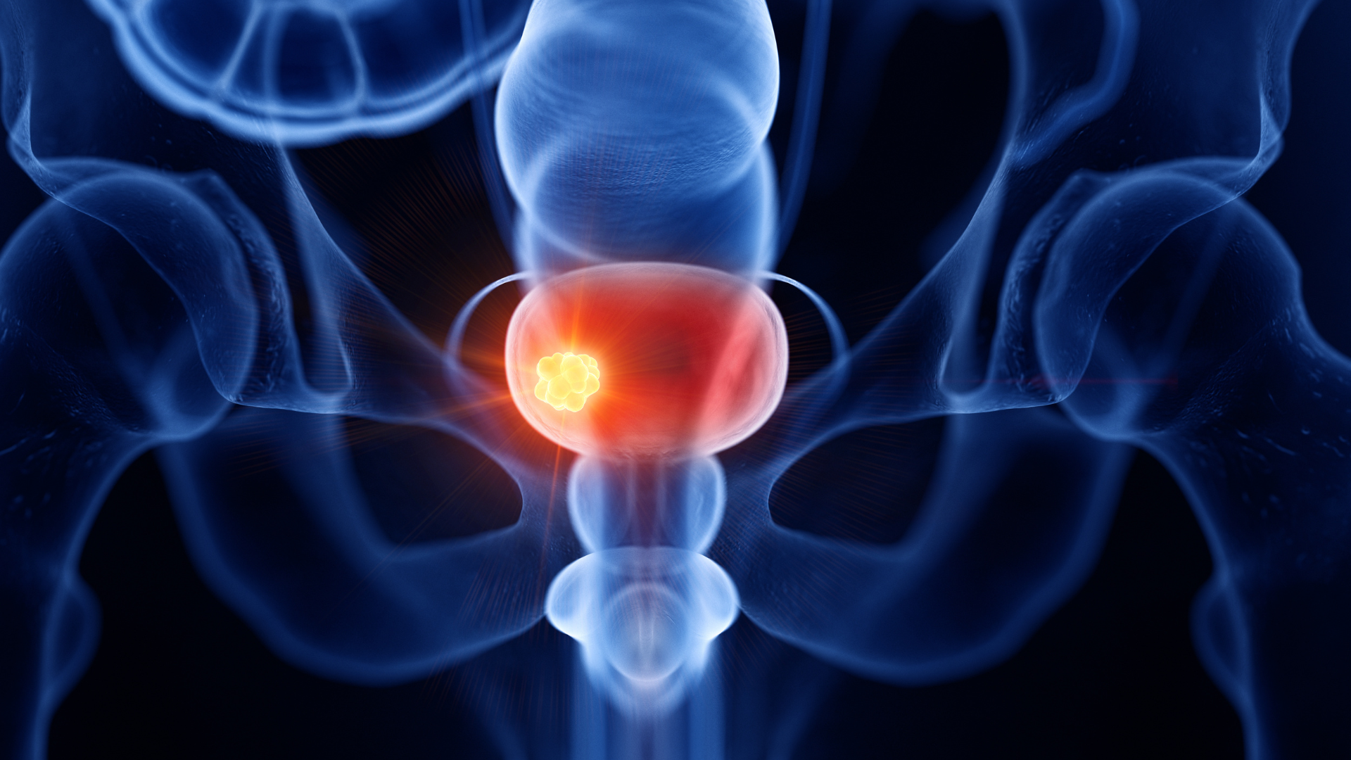 FDA Approves PADCEV and Keytruda Perioperative Therapy: A Game-Changer ...